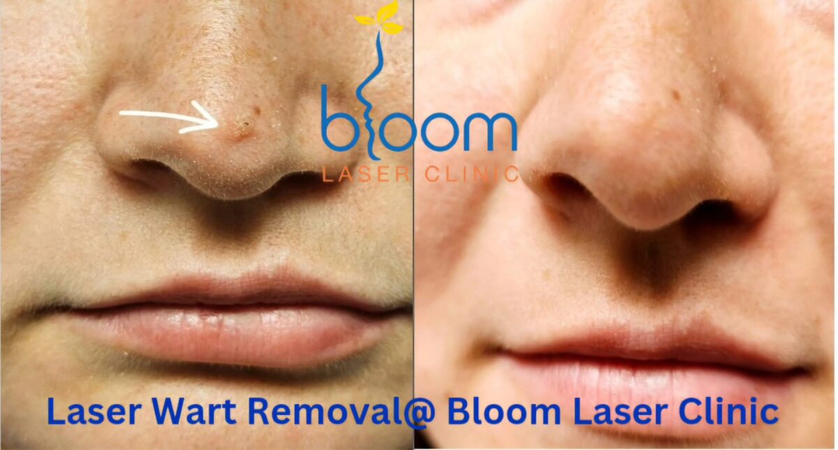 Laser treatment for warts and Molluscum contagiosum - Bloom Laser Clinic
